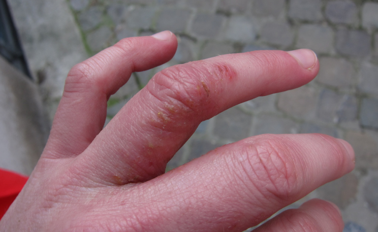 Dyshidrotic eczema (Dyshidrosis): Symptoms, Causes, Treatment and ...