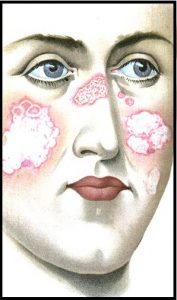 Lupus rash - Types, Effects, Diagnoses, Treatments, Prevention and ...