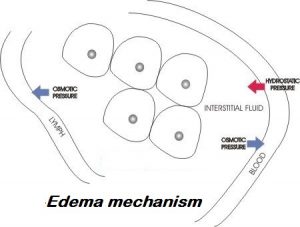 Anasarca - Definition, Pictures, Causes and Treatment - Drugs Details