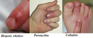 Herpetic whitlow - What is, Causes, Symptoms, Treatments and Pictures ...