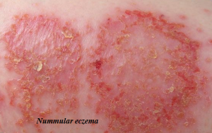 Nummular eczema - Definition, Complications, Causes, Treatments and ...